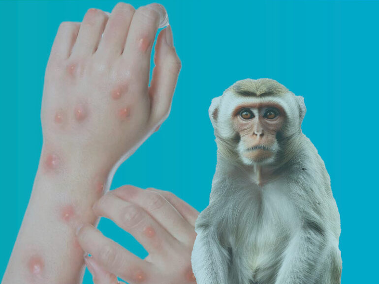 Oman’s Health Ministry issues advisory on monkeypox prevention and ...